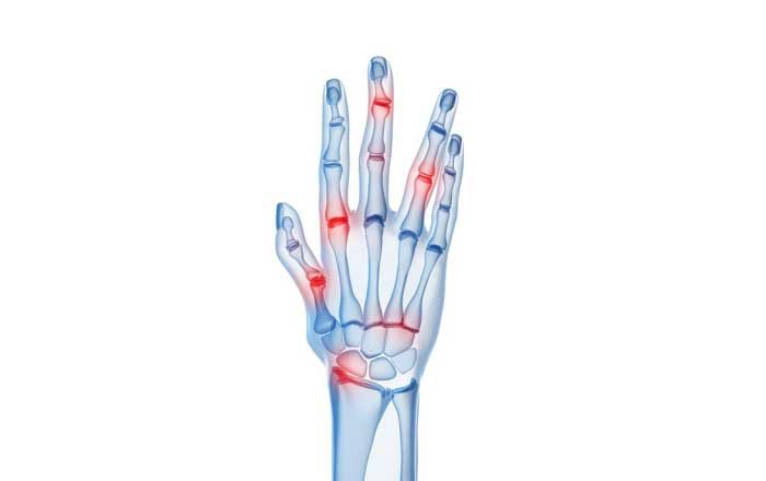 Poliartrita reumatoidă: simptome, diagnosticare şi tratament - Doftoria.ro